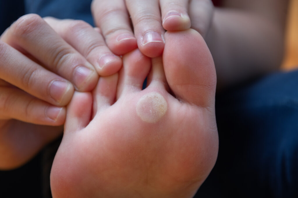 Liktornar Och Hudvalkar Orsaker Symptom Och Behandlingar Liktornar Och Hudvalkar Orsaker Symptom Och Behandlingar